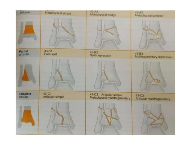 Pilon fracture | PPTX | Death, Injury, or Military Conflict | Sensitive ...