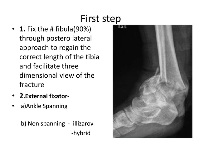 Pilon fracture | PPTX | Death, Injury, or Military Conflict | Sensitive ...