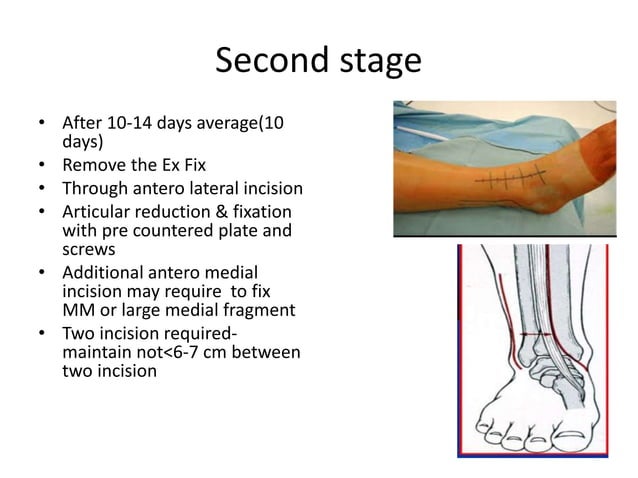 Pilon fracture | PPTX | Death, Injury, or Military Conflict | Sensitive ...