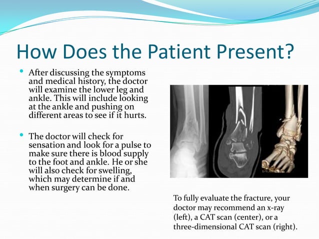 Pilon Fractures | PPTX | Death, Injury, or Military Conflict ...