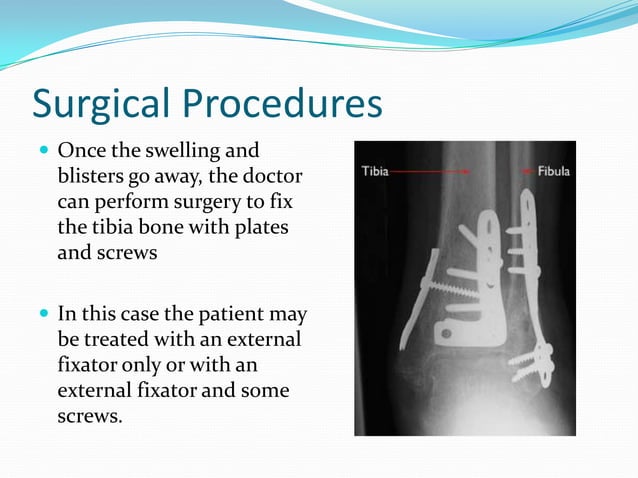 Pilon Fractures | PPTX | Death, Injury, or Military Conflict ...