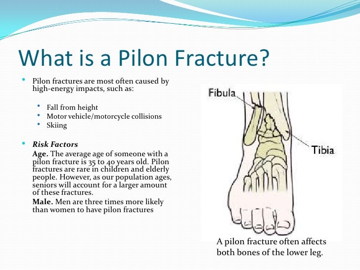 Pilon Fracture Anatomy Pilon Fracture Anatomy