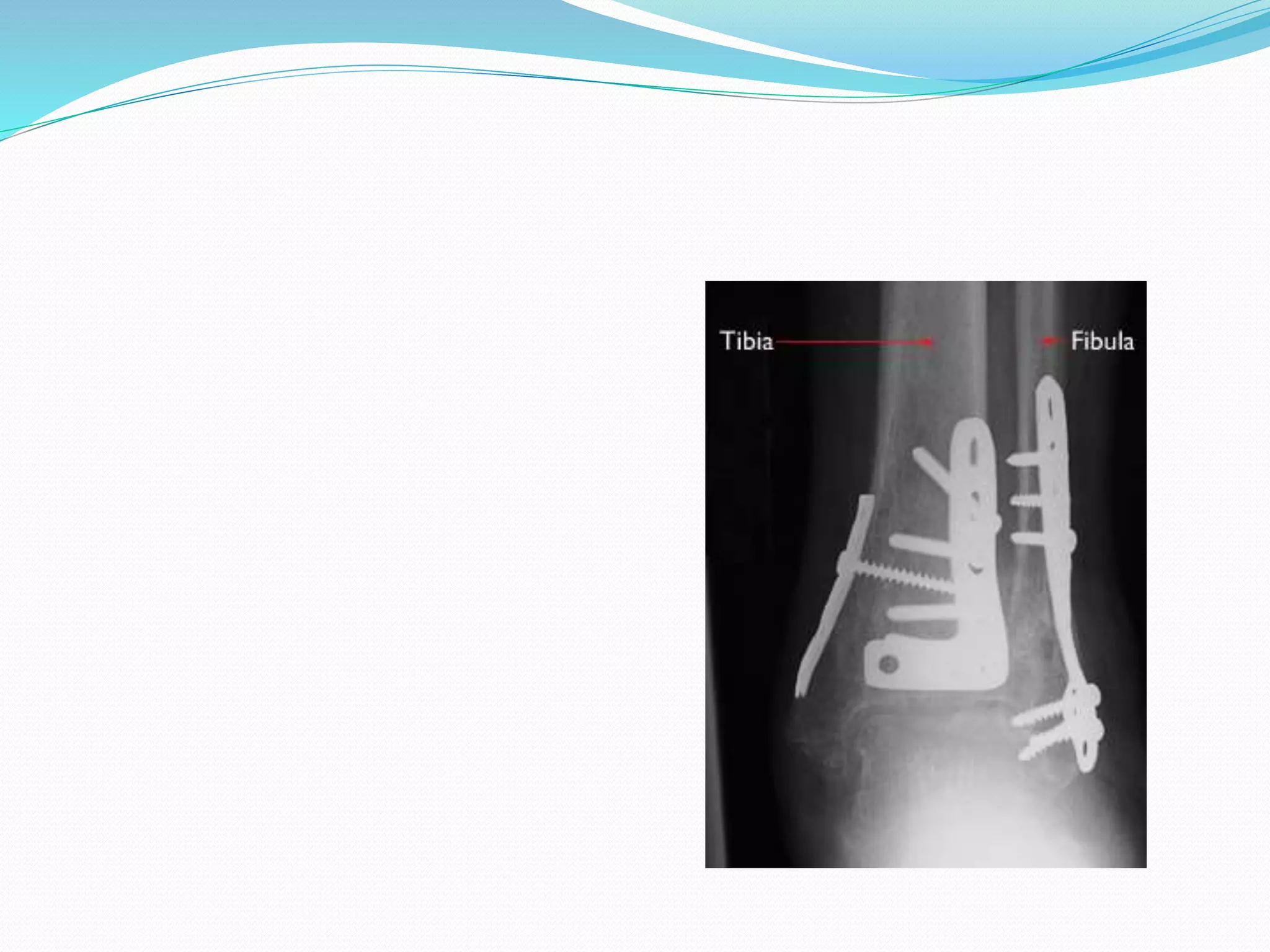 Pilon fractures | PPTX