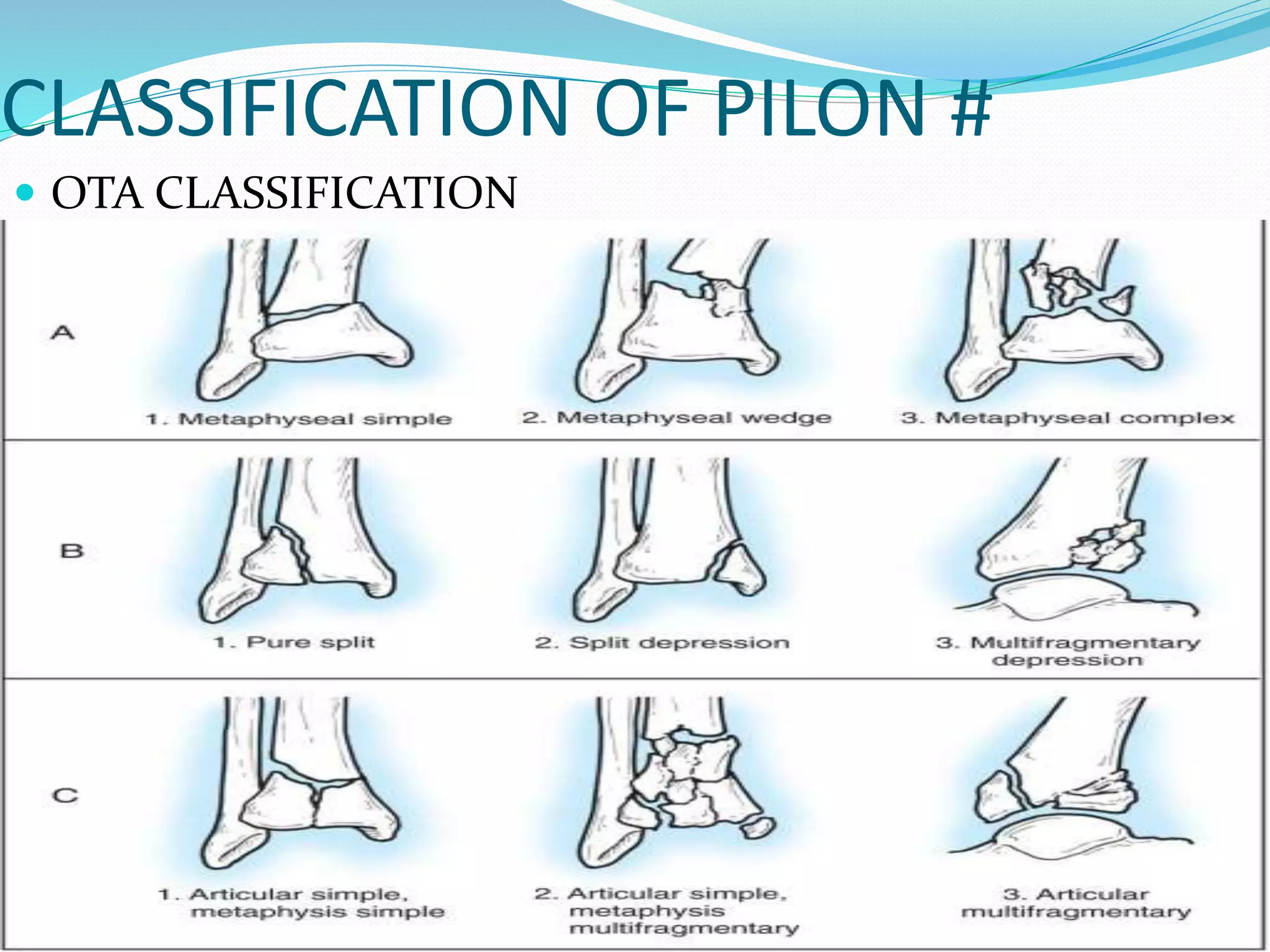 Pilon fractures | PPTX
