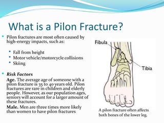 Pilon fractures | PPTX