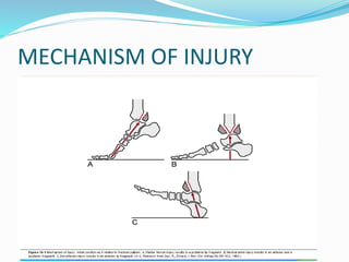 Pilon fractures | PPTX