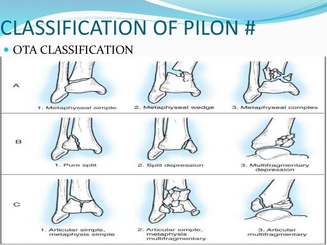 Pilon fractures Pilon fractures
