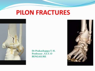 Pilon fractures | PPTX