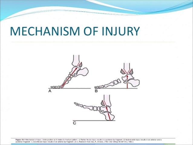Pilon fractures | PPTX | Death, Injury, or Military Conflict ...
