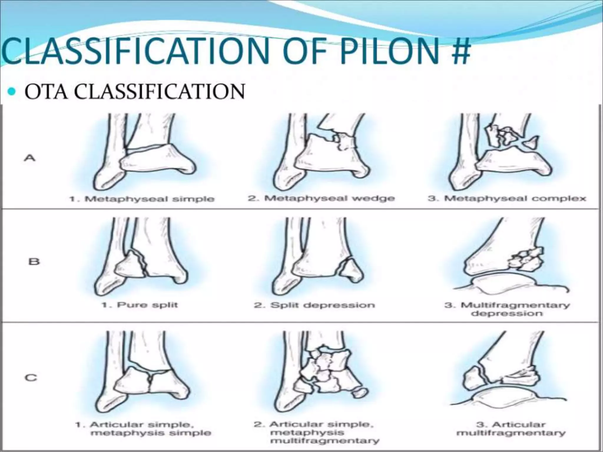 Pilon fractures | PPTX