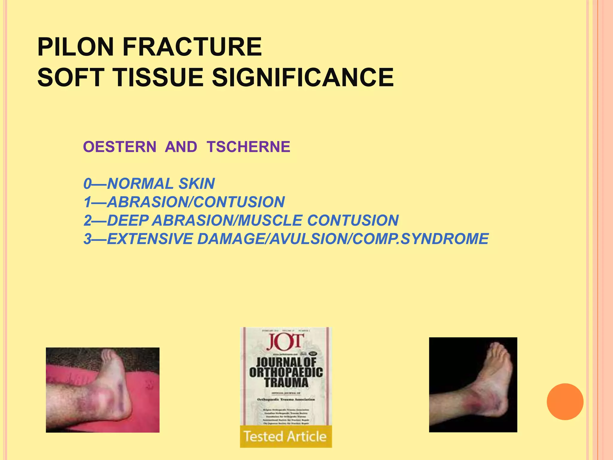 Pilon fractures reduction and fixation technics-dr mohamed ashraf-govt ...