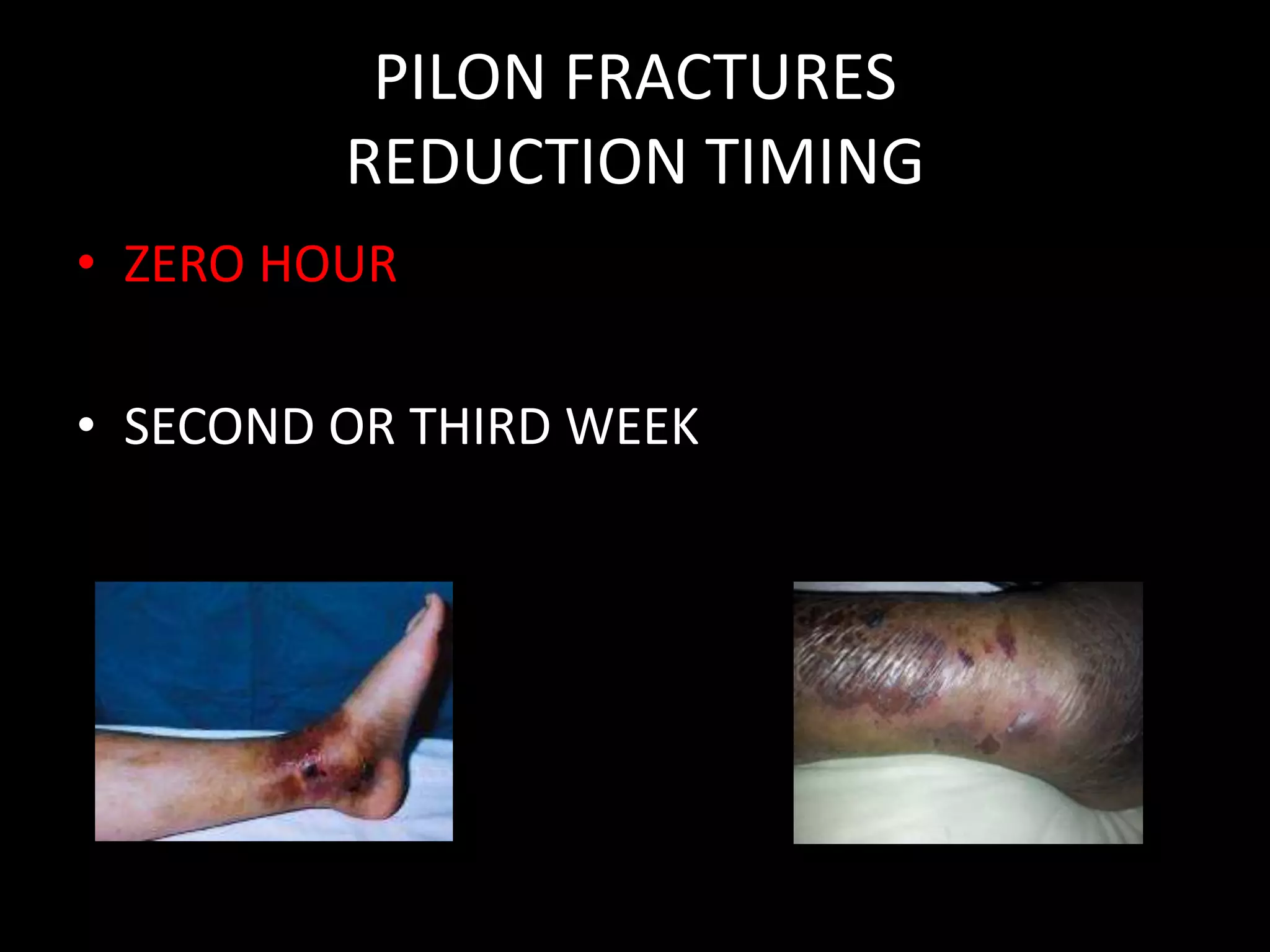 Pilon fractures reduction and fixation technics-dr mohamed ashraf-govt ...