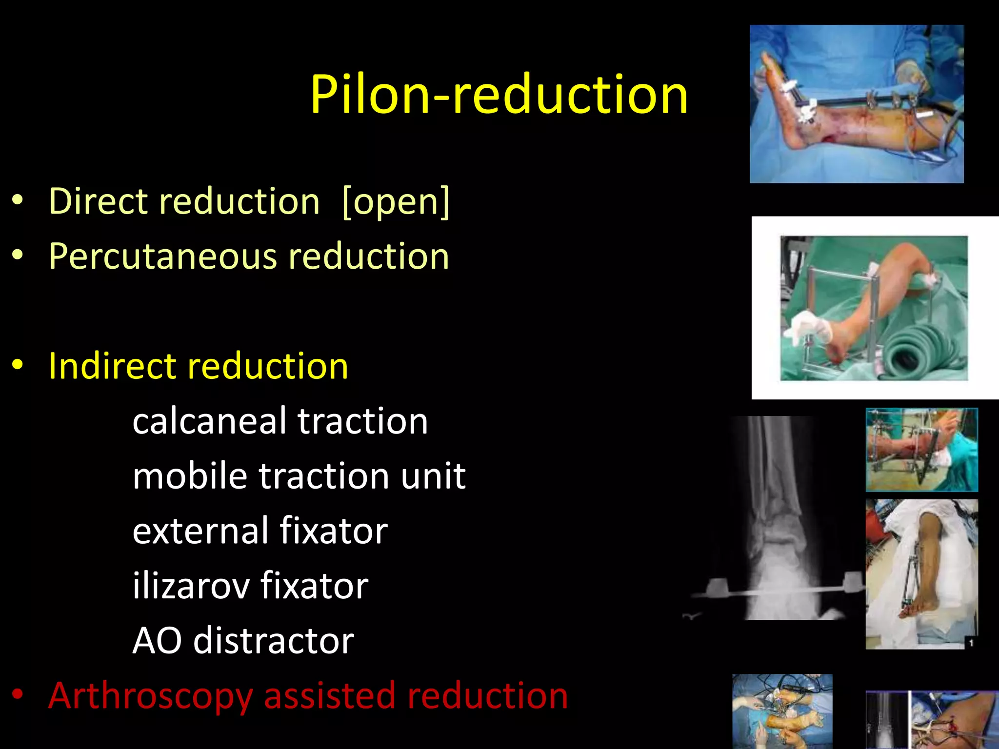 Pilon fractures reduction and fixation technics-dr mohamed ashraf-govt ...