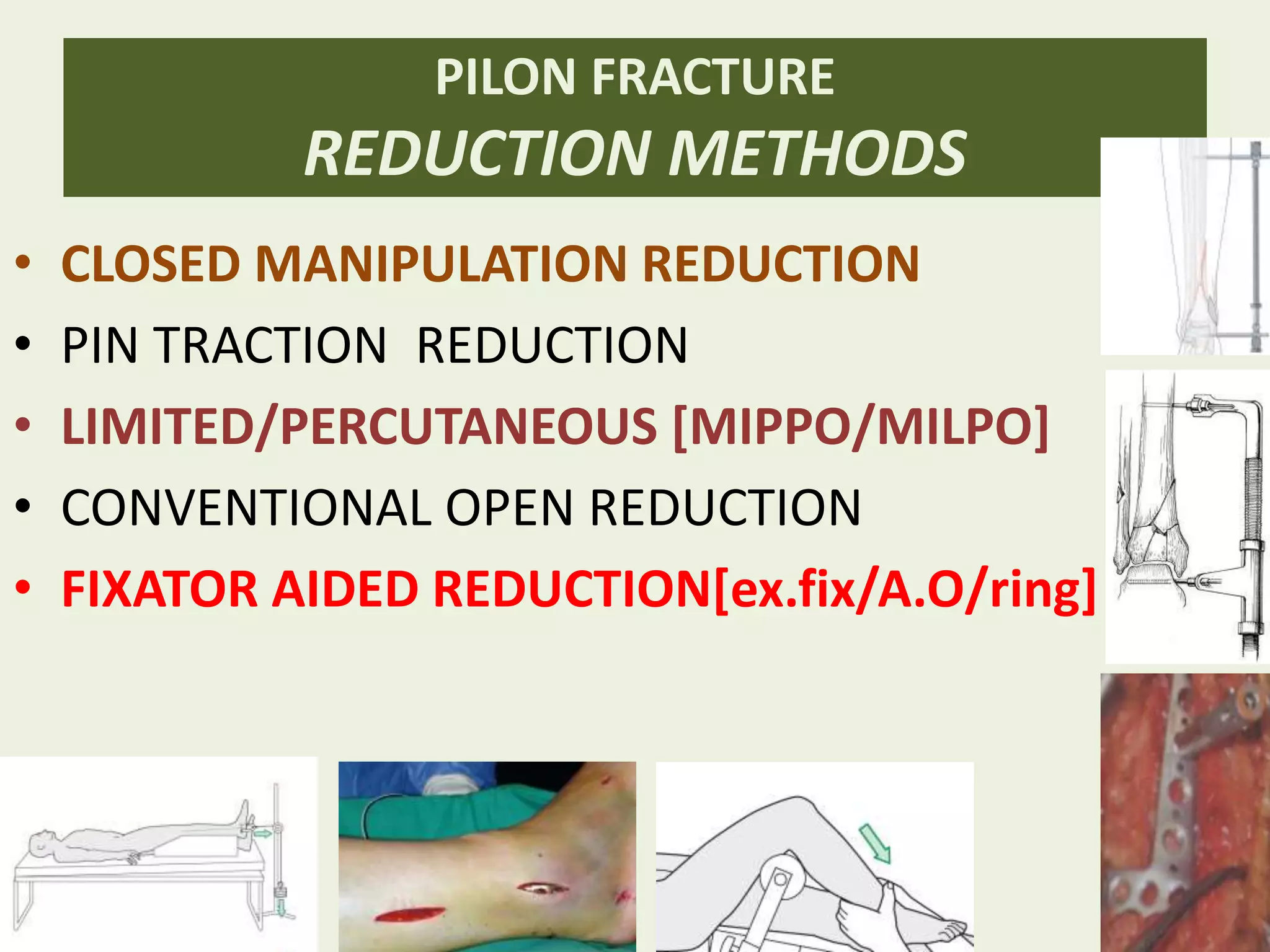 Pilon fractures reduction and fixation technics-dr mohamed ashraf-govt ...