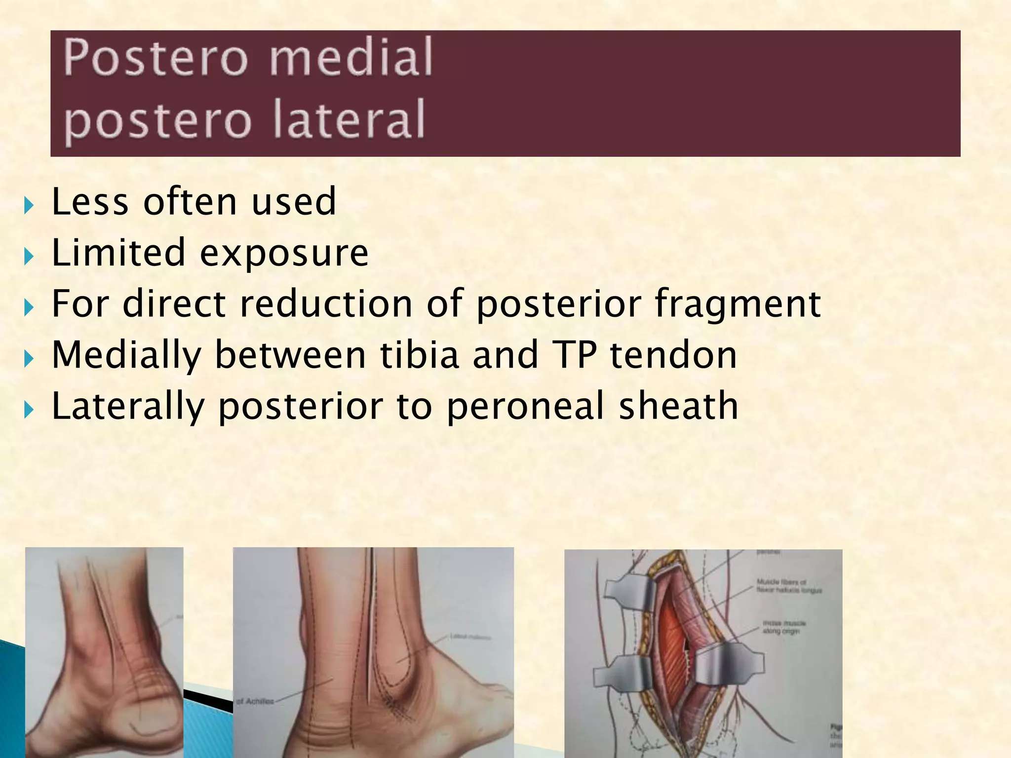 Pilon fractures reduction and fixation technics-dr mohamed ashraf-govt ...