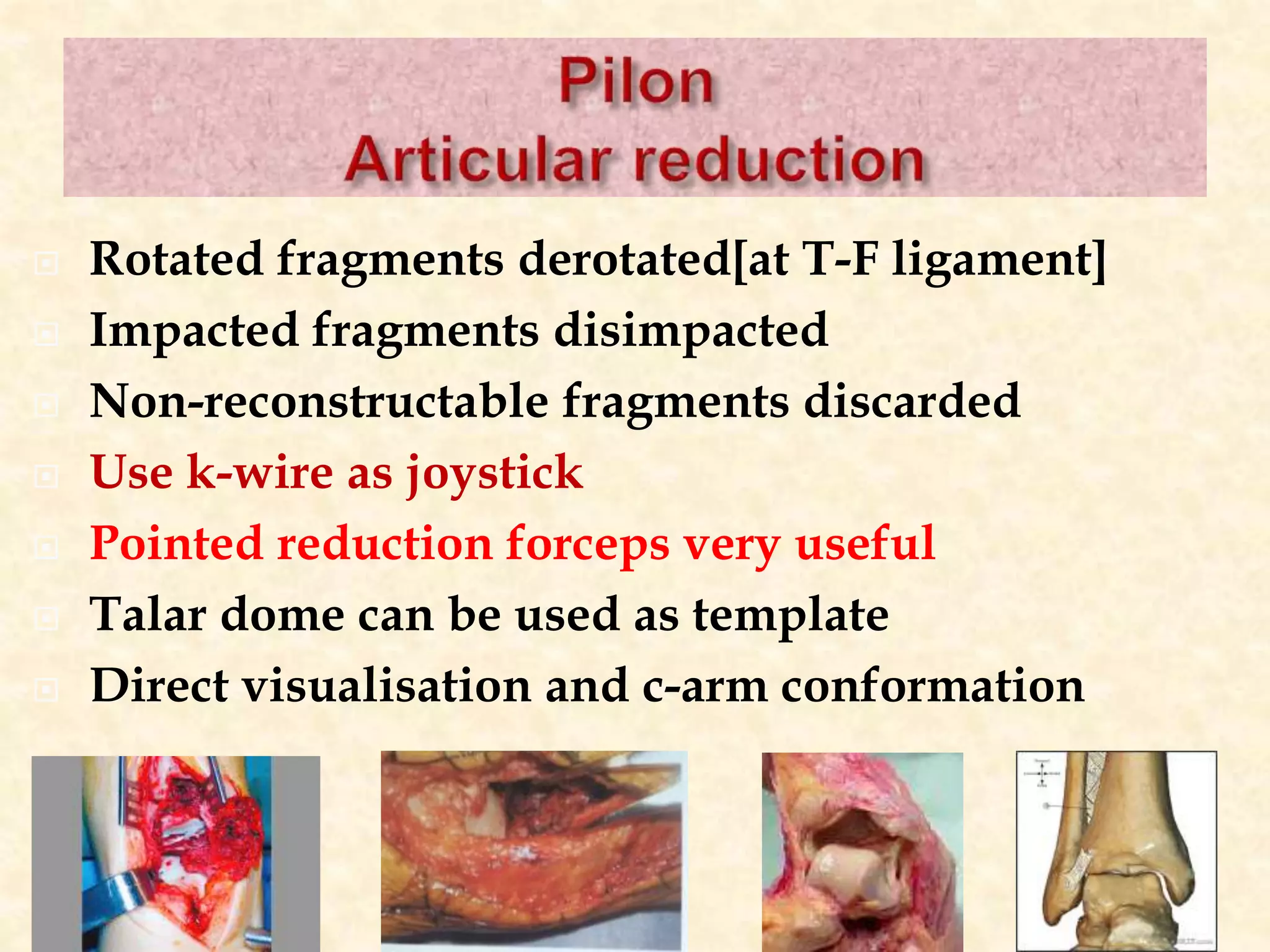 Pilon fractures reduction and fixation technics-dr mohamed ashraf-govt ...