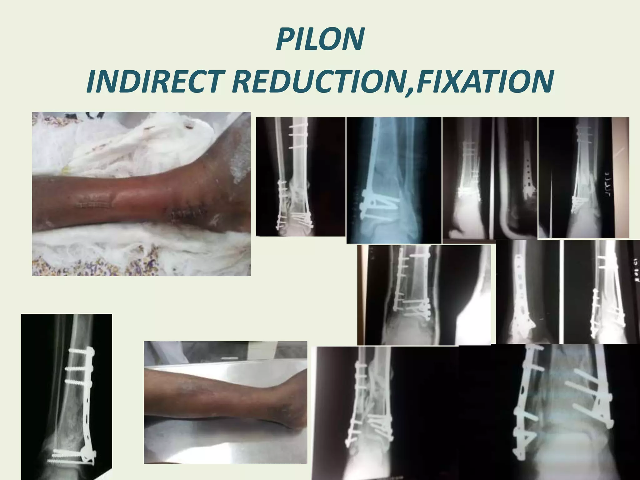 Pilon fractures reduction and fixation technics-dr mohamed ashraf-govt ...