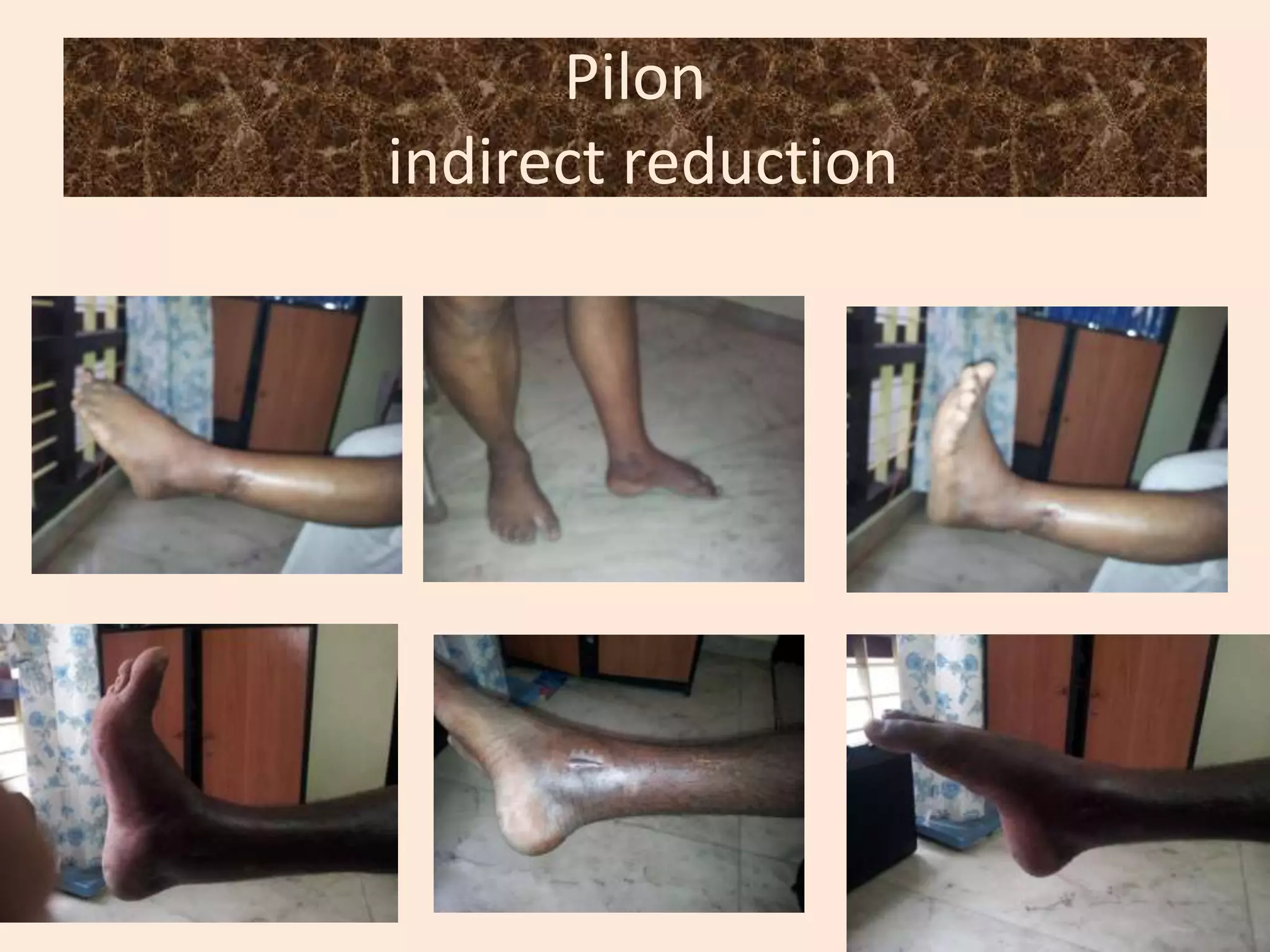 Pilon fractures reduction and fixation technics-dr mohamed ashraf-govt ...