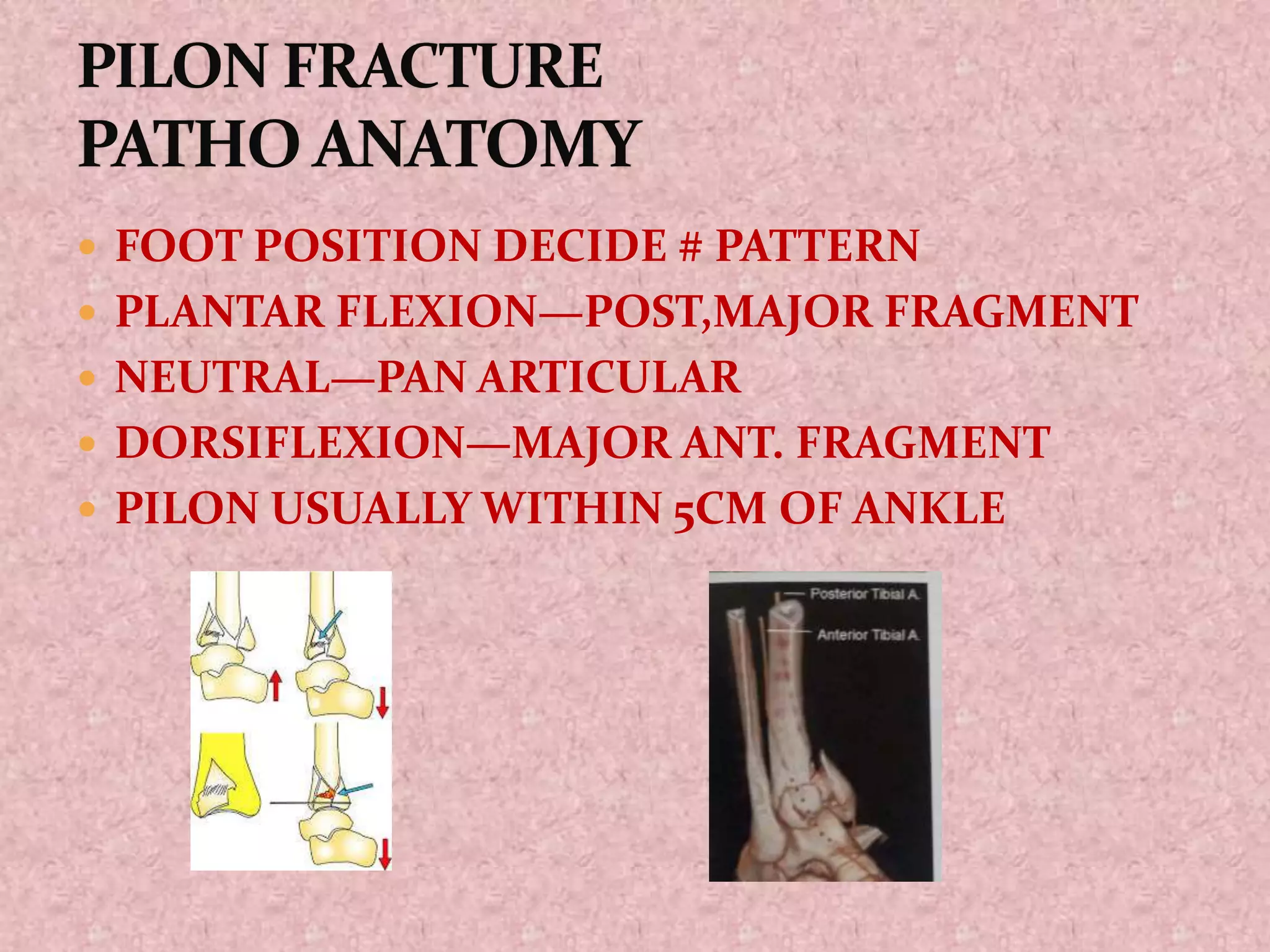 Pilon fractures reduction and fixation technics-dr mohamed ashraf-govt ...