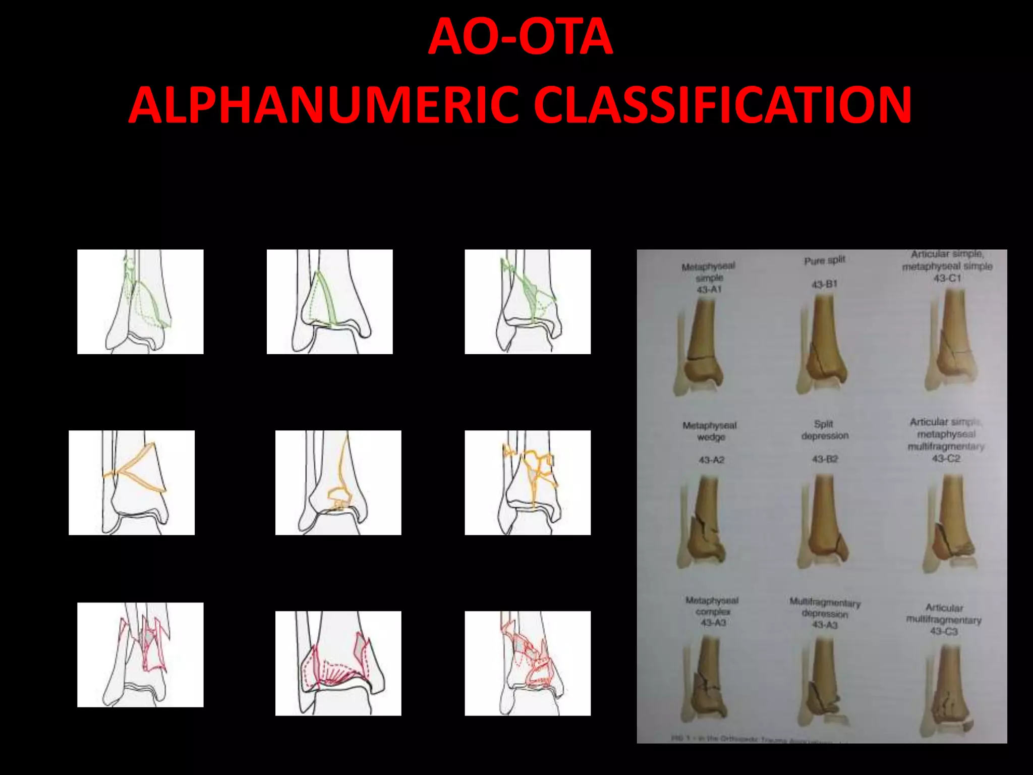 Pilon fractures reduction and fixation technics-dr mohamed ashraf-govt ...