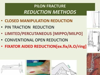 Pilon fractures reduction and fixation technics-dr mohamed ashraf-govt ...