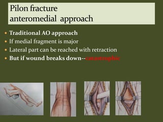 Pilon fractures reduction and fixation technics-dr mohamed ashraf-govt ...