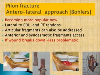 Pilon fractures reduction and fixation technics-dr mohamed ashraf-govt ...