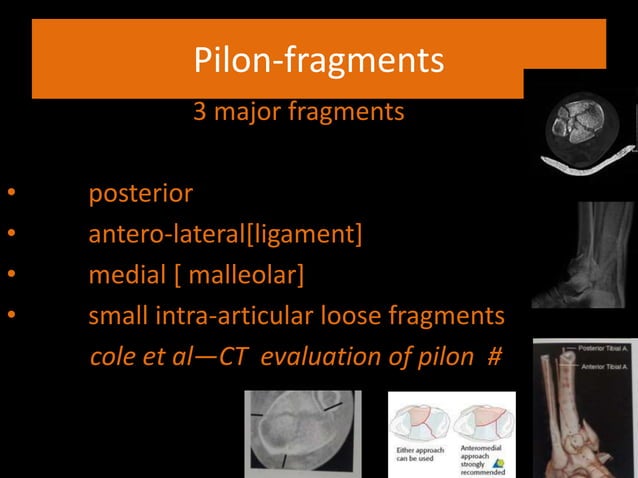 Pilon fractures reduction and fixation technics-dr mohamed ashraf-govt ...