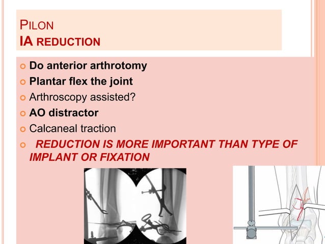Pilon fractures reduction and fixation technics-dr mohamed ashraf-govt ...
