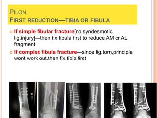 Pilon fractures reduction and fixation technics-dr mohamed ashraf-govt ...