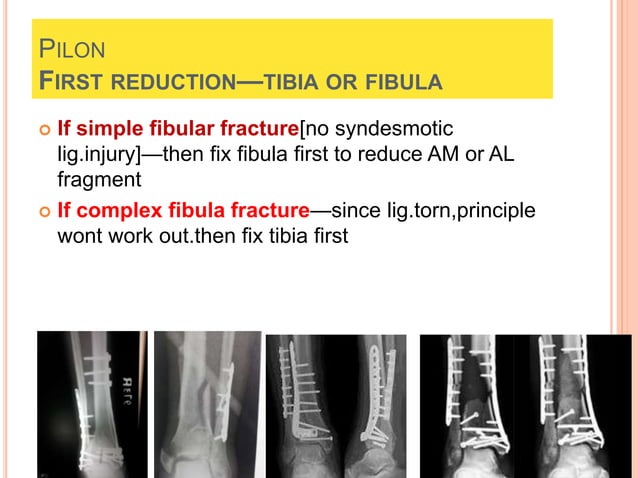 Pilon fractures reduction and fixation technics-dr mohamed ashraf-govt ...