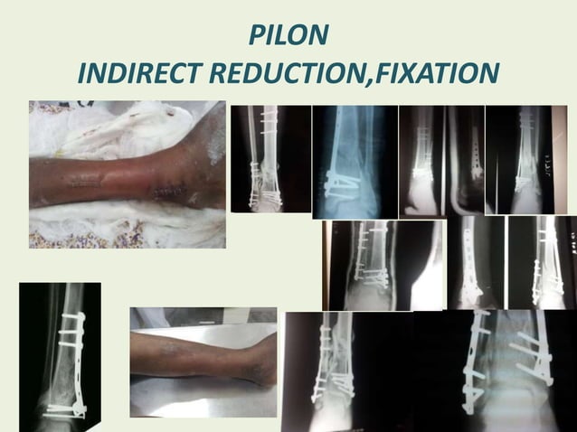 Pilon fractures reduction and fixation technics-dr mohamed ashraf-govt ...