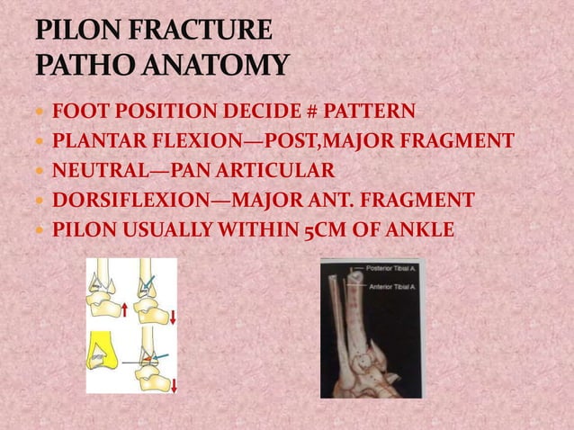 Pilon fractures reduction and fixation technics-dr mohamed ashraf-govt ...