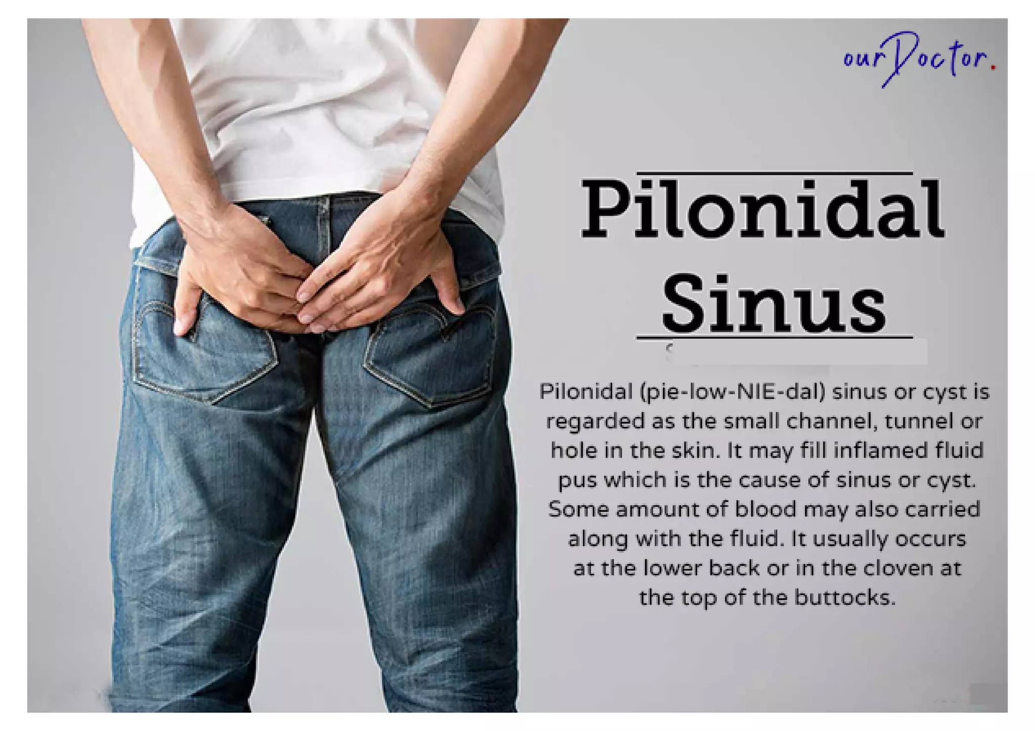 Pilonidal sinus | PDF
