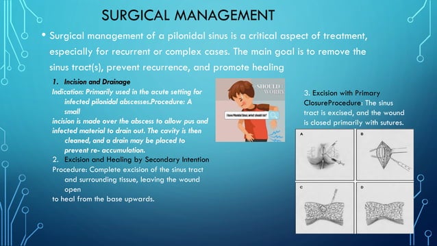 pilonidal sinus presentation(anatomy,pathology and management).ppt ...