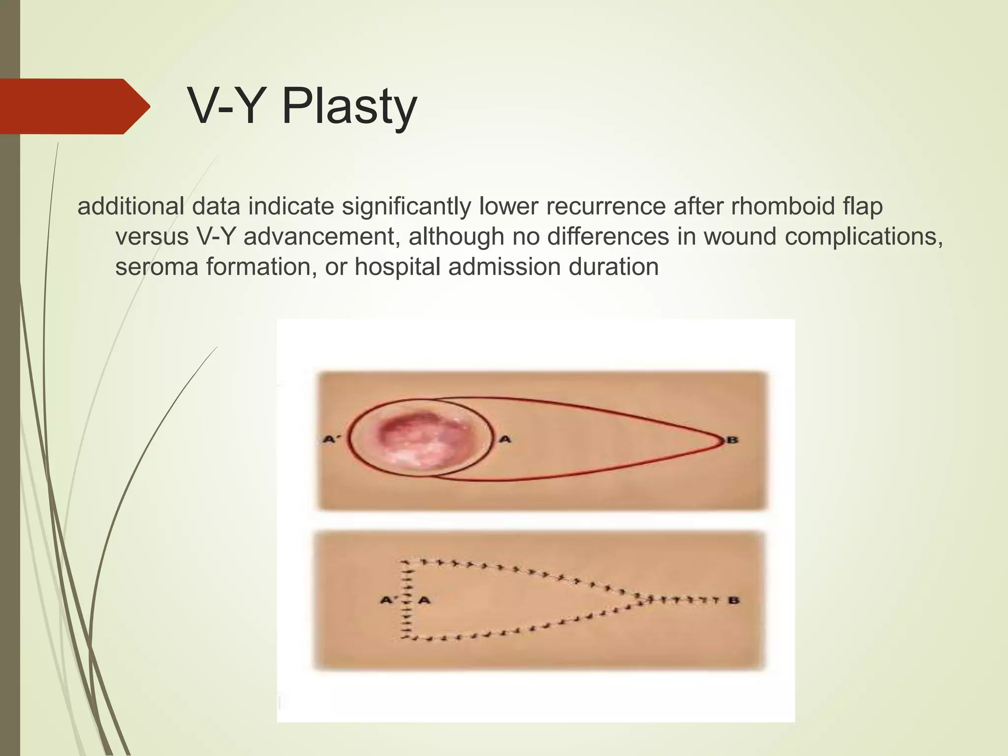 Pilonidal Disease Management Approach Pptx