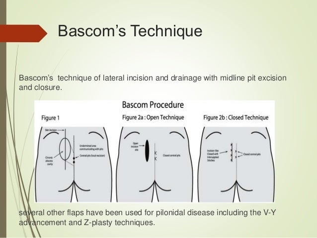 Pilonidal Disease Management Approach