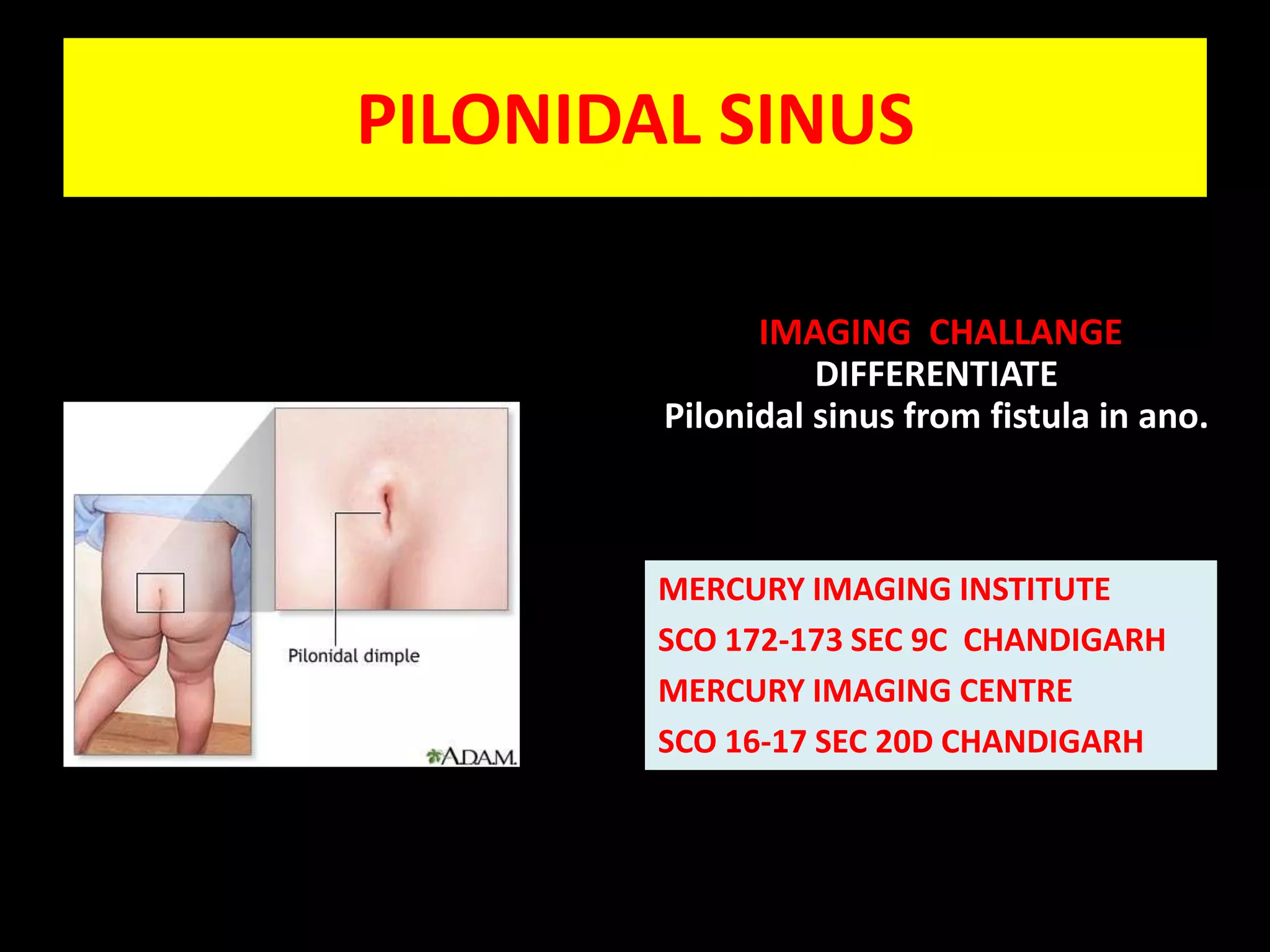 Pilonidal sinus | PPTX