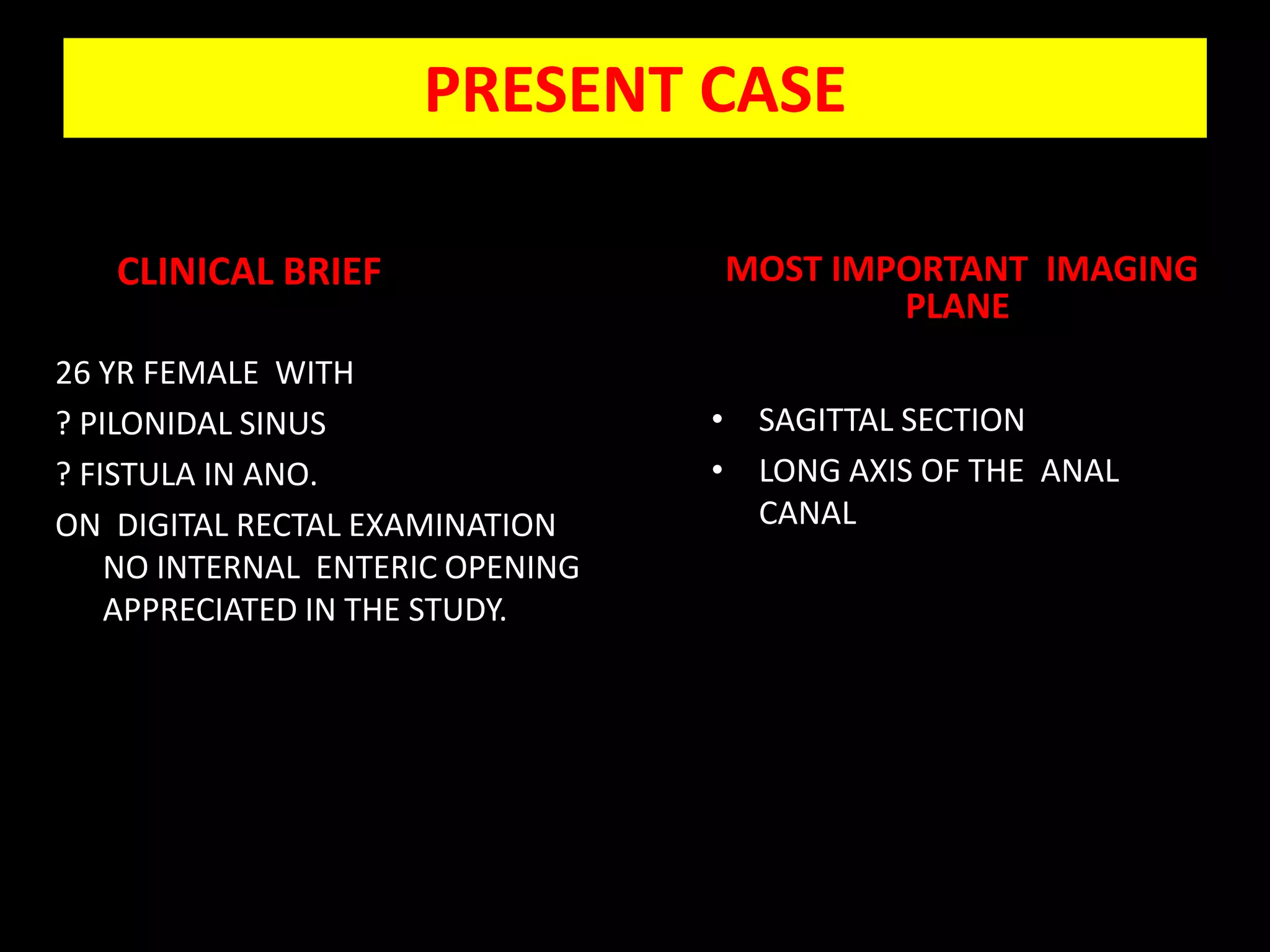 Pilonidal sinus | PPTX