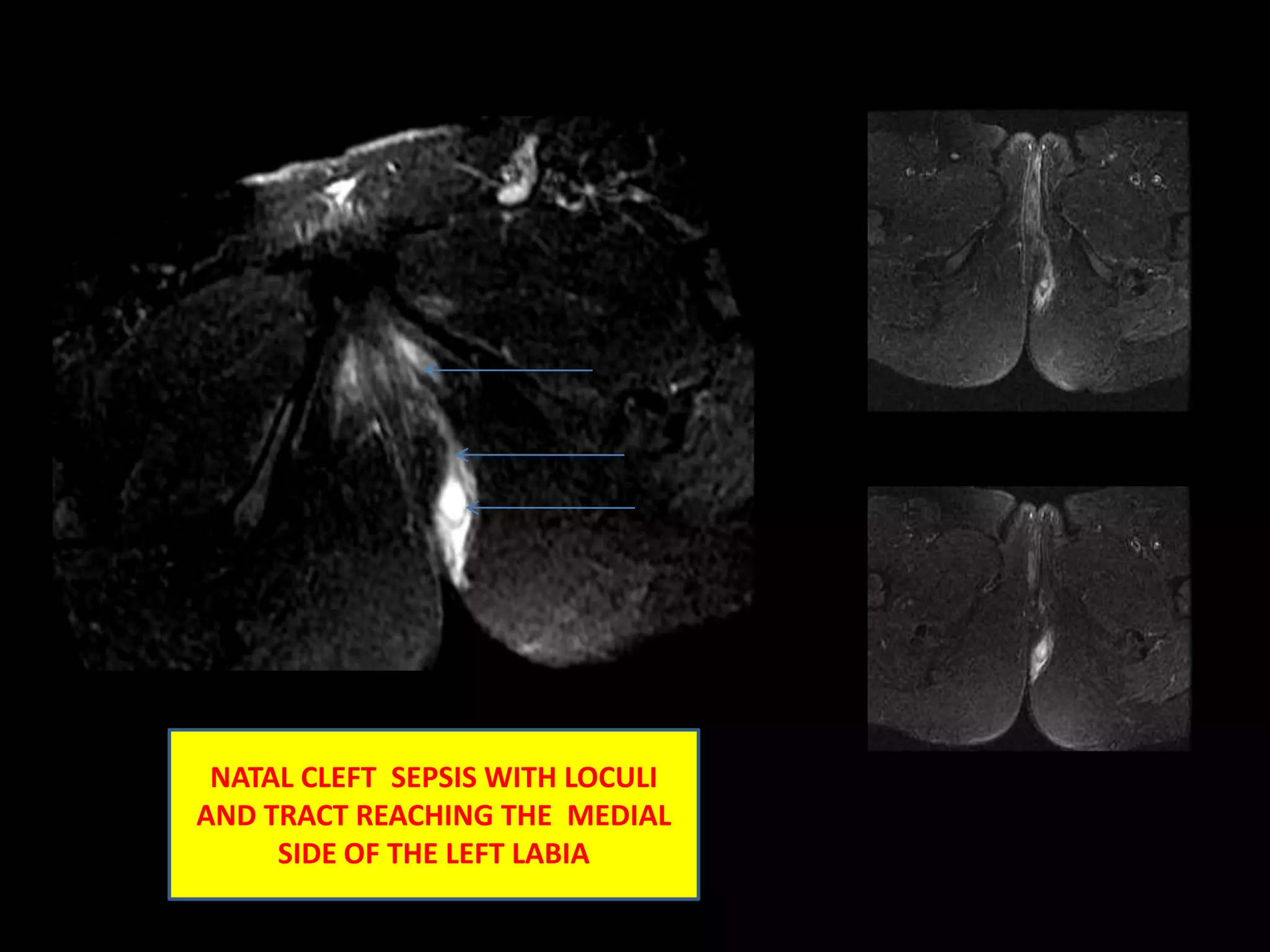 Pilonidal sinus | PPTX