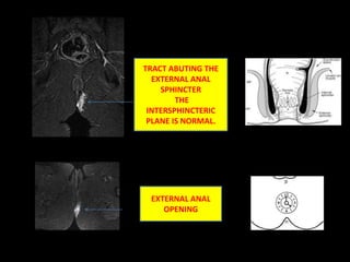 Pilonidal sinus | PPTX