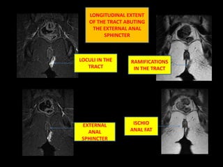 Pilonidal sinus | PPTX