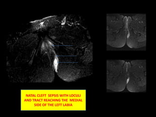 Pilonidal Cyst Mri