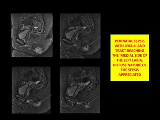 Pilonidal Cyst Mri
