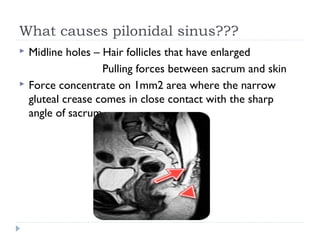 Pilonidal sinus | PPT