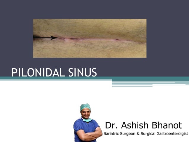 Pilonidal Sinus Treatment