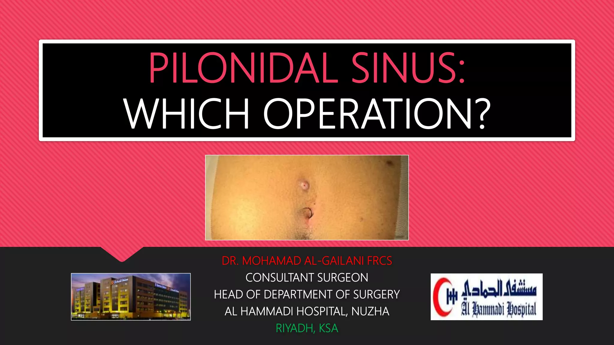 Pilonidal Sinus: Which Operation? | PPTX
