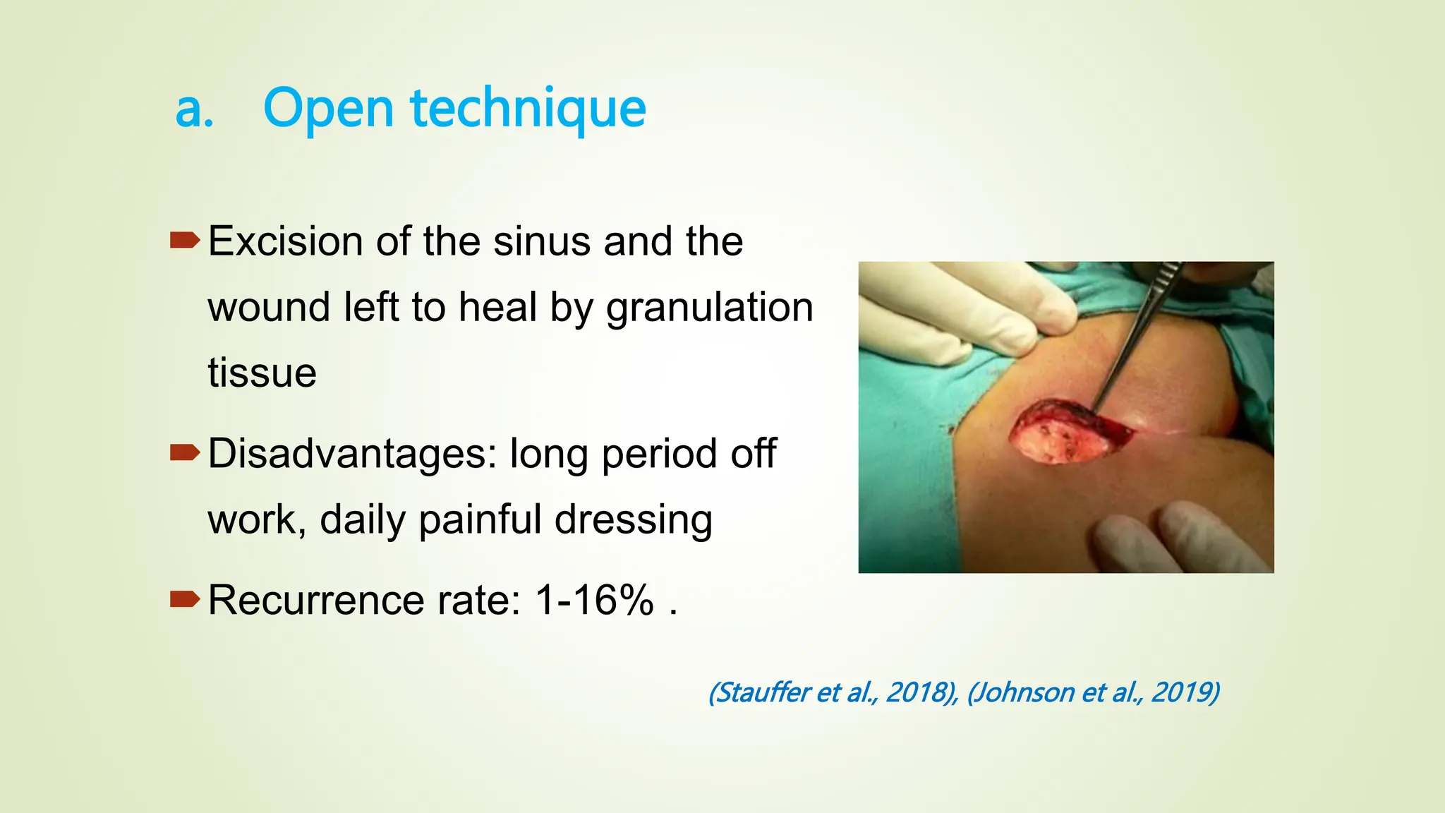 pilonidal sinus.pptx