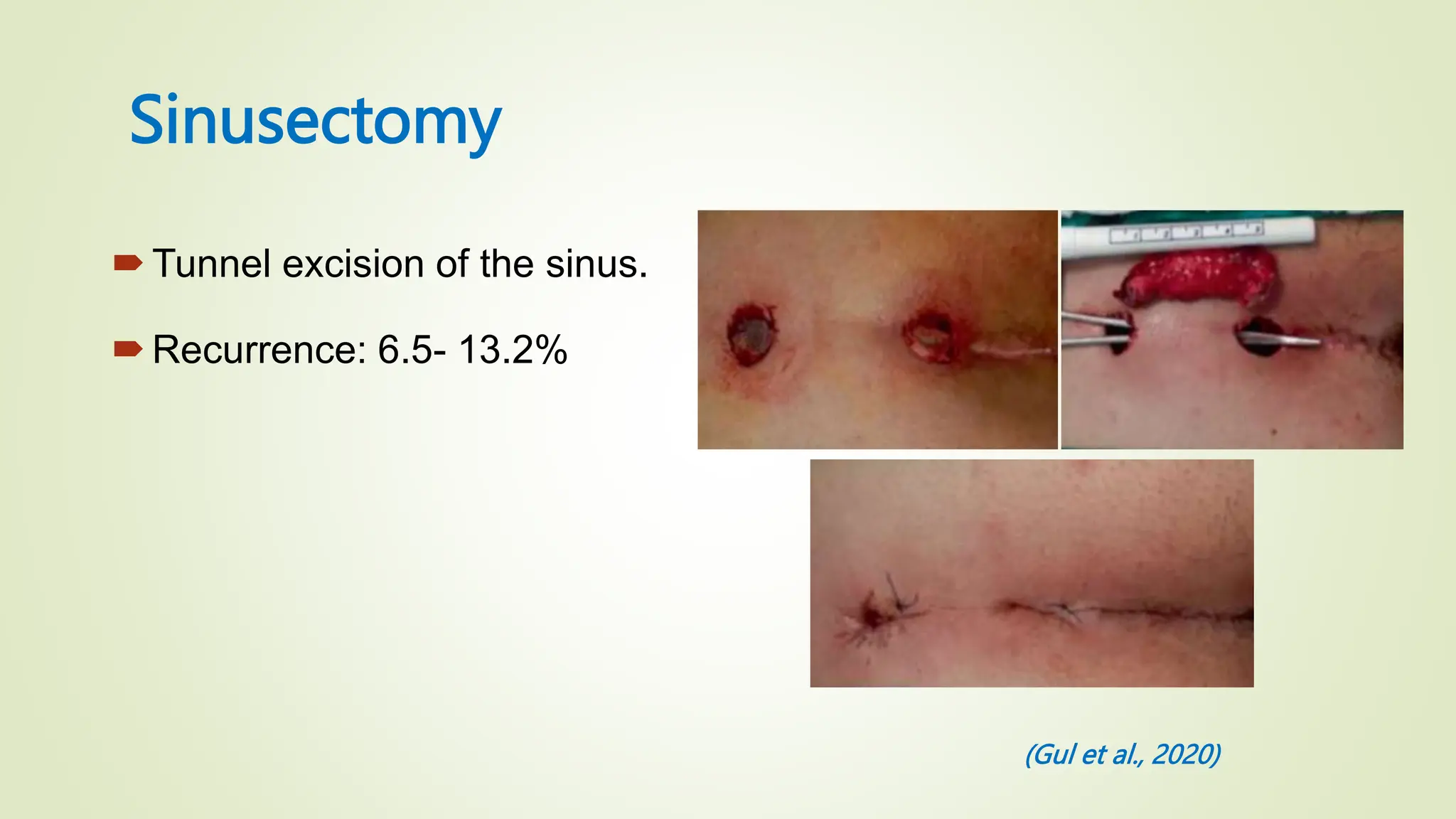 pilonidal sinus.pptx
