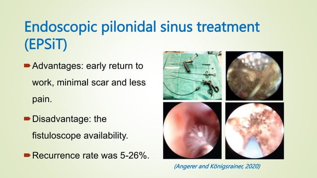 pilonidal sinus.pptx